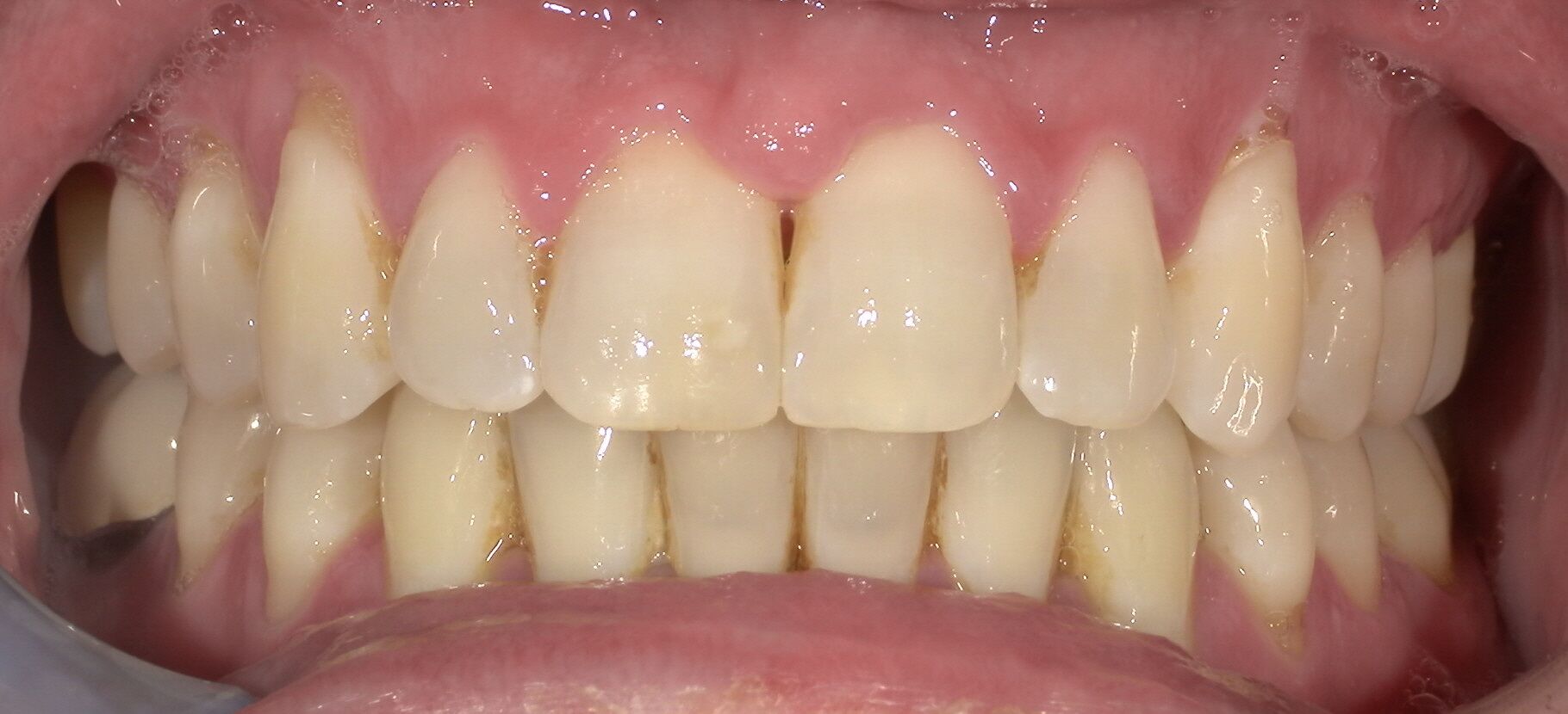 Marpe Expander | Randall Orthodontics